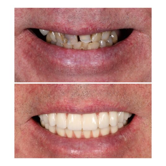 Patient Success Stories - Premier Oral Surgery Norwalk Connecticut